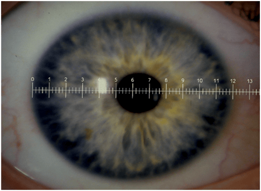 How to Measure HVID