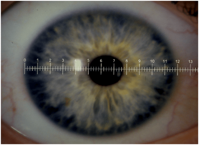 How to Measure HVID