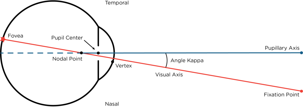 3 Factors Associated with Multifocal Misalignment