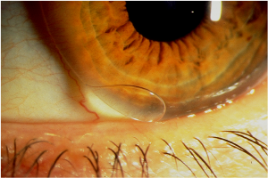 Trouble-shooting the Fit of a Custom Soft Contact Lens