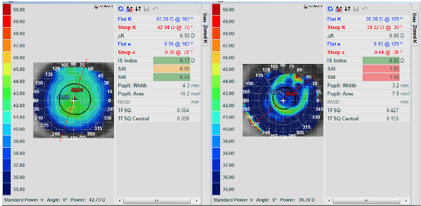 SpecialEyes Distance Center Multifocal: Case #2 from Treehouse Eyes