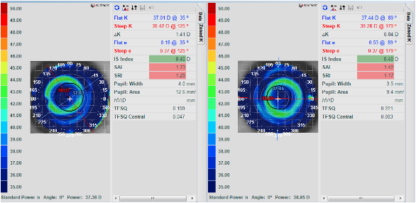 SpecialEyes Distance Center Multifocal: Case #2 from Treehouse Eyes