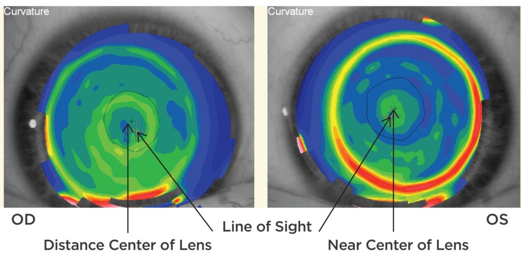 Effects of Aligning the Multifocal Optics with the Visual Axis