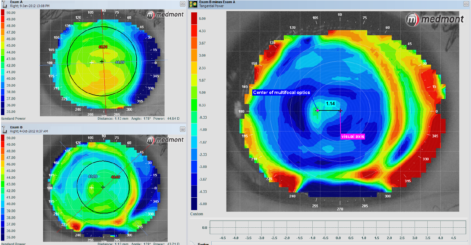 3 Ways to Identify Multifocal Misalignment Issues