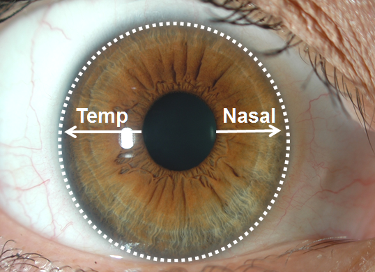 3 Factors Associated with Multifocal Misalignment