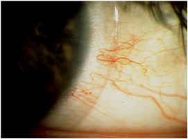 Trouble-shooting the Fit of a Custom Soft Contact Lens