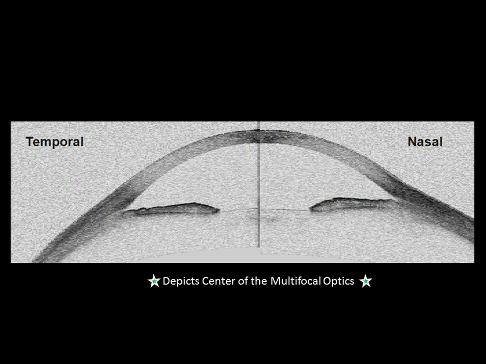 3 Factors Associated with Multifocal Misalignment