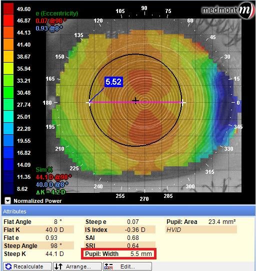 Accurate Pupil Size Measurement For Fitting SpecialEyes’ Multifocal ...