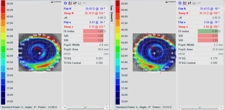 Case Study #3: Myopia Management for High Myopes