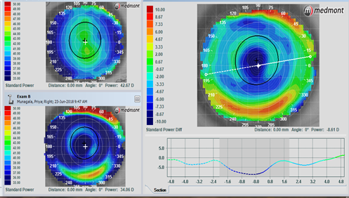 Case Study #3: Myopia Management for High Myopes