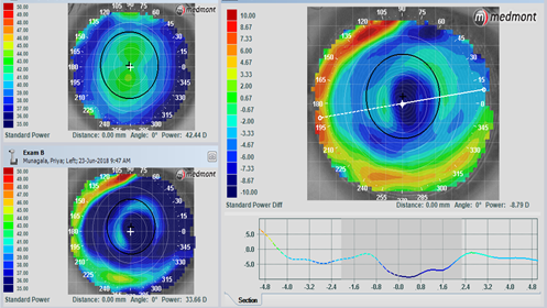 Case Study #3: Myopia Management for High Myopes