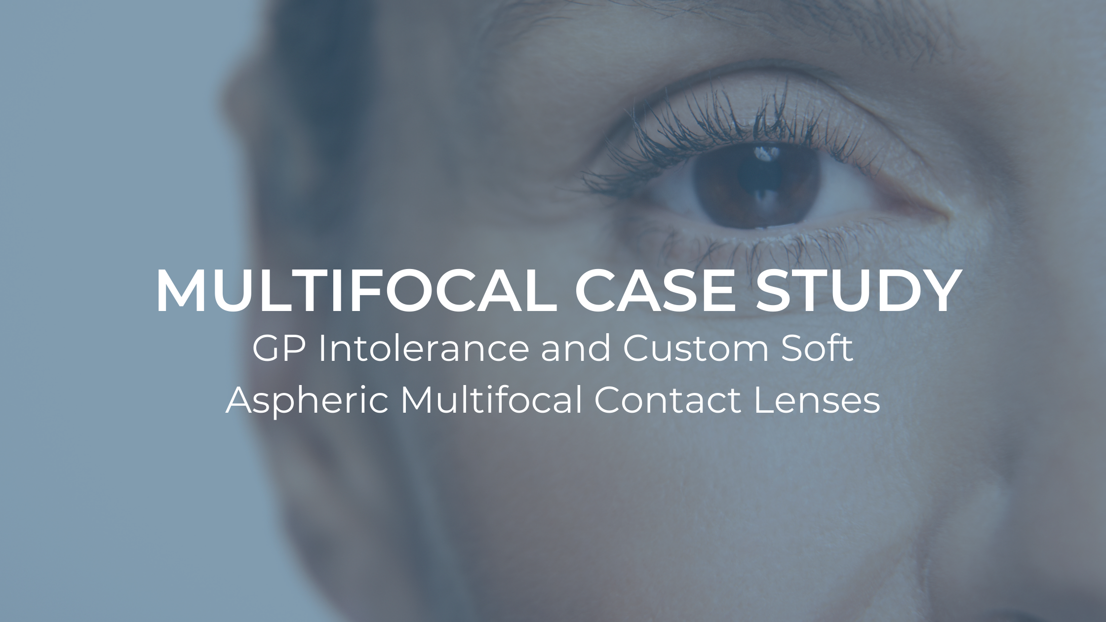 Multifocal Case Study: GP Intolerance and Custom Soft Aspheric ...