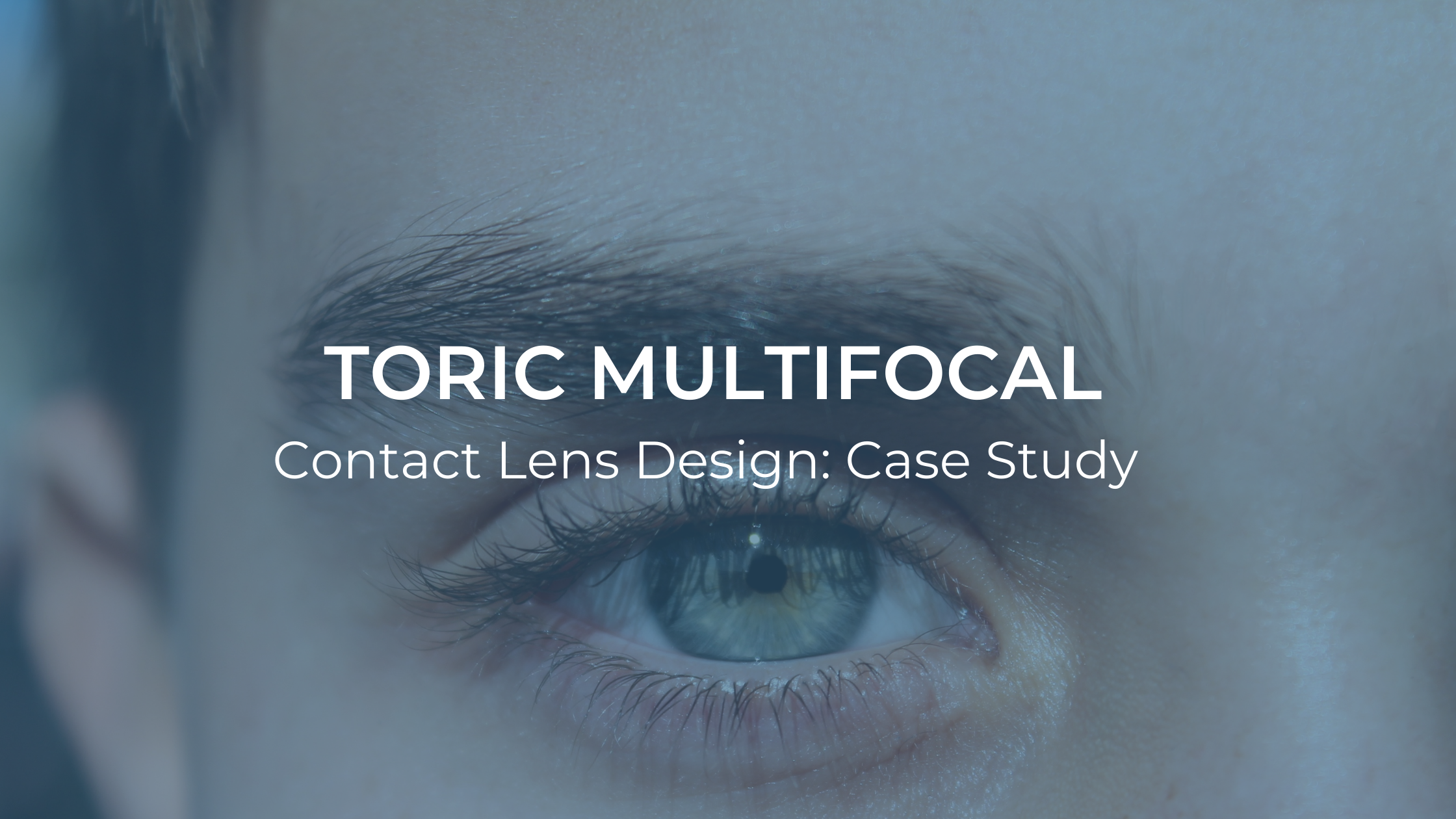 Toric Multifocal Contact Lens Design: Case Study