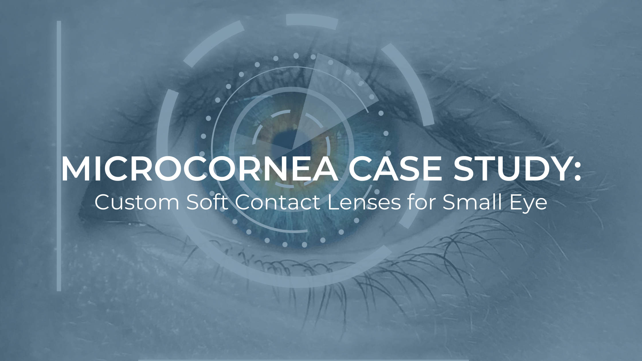 Microcornea Case Study: Custom Soft Contact Lenses for Small Eye