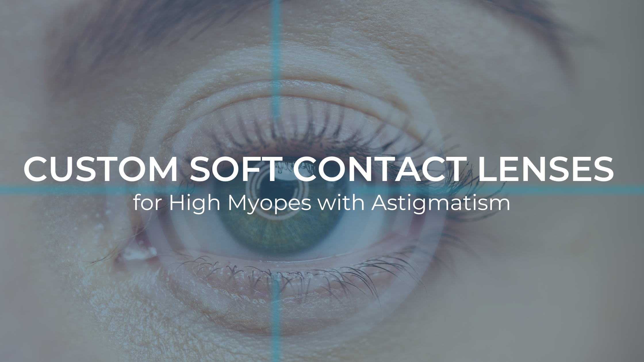 Custom Soft Contact Lenses for High Myopes with Astigmatism
